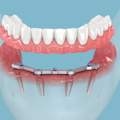 What Is All-on-X and How Does It Work? A Guide for Hermosa Beach ...